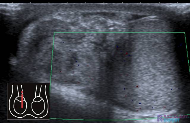 Scrotal ultrasound
