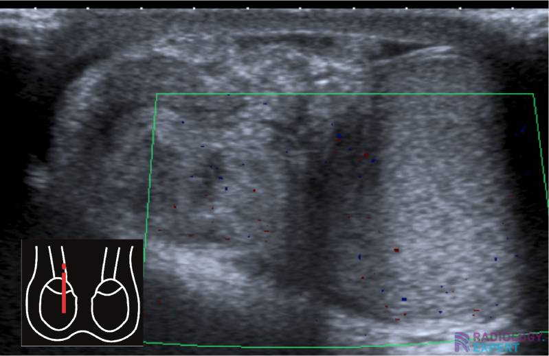 Scrotal ultrasound