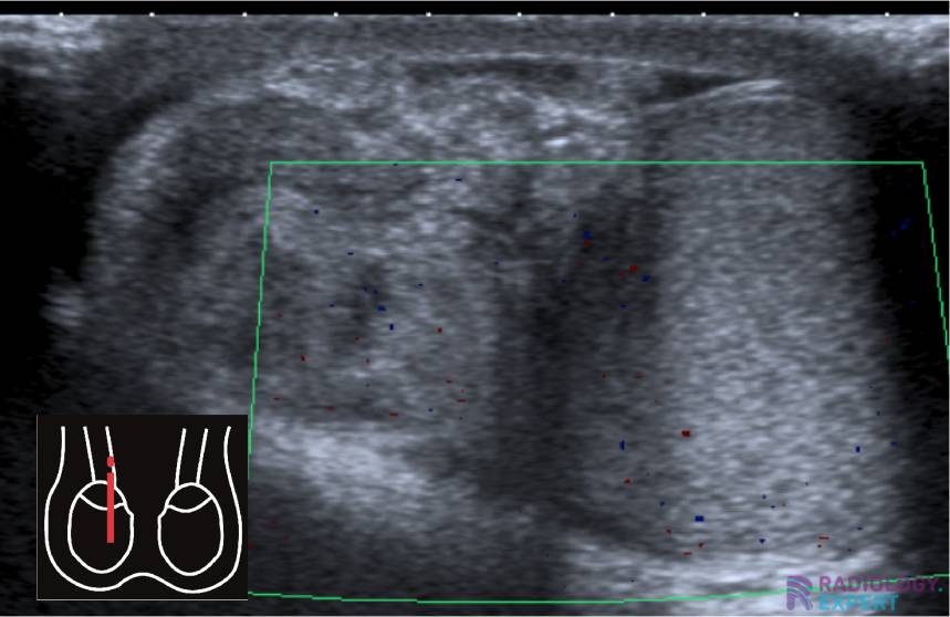 Scrotal ultrasound