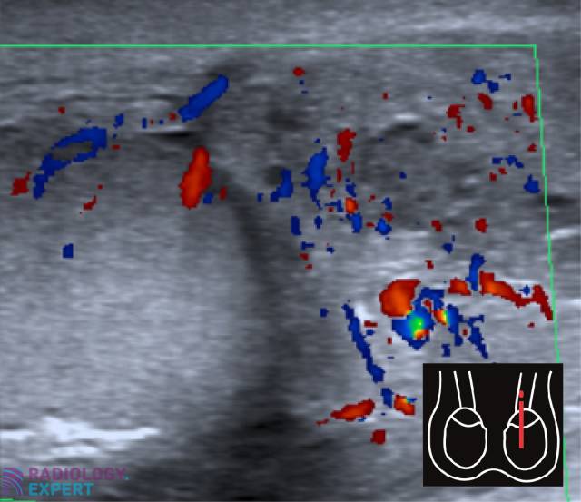 Scrotal ultrasound