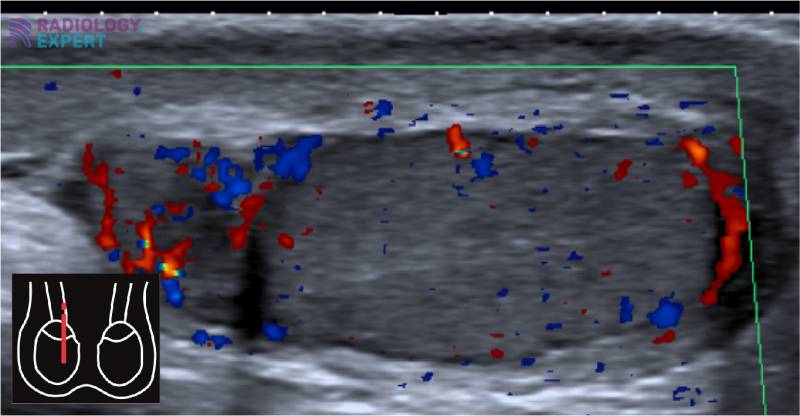 Scrotal ultrasound