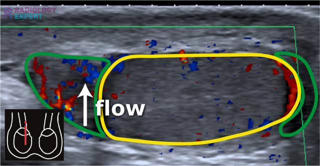 Scrotal ultrasound
