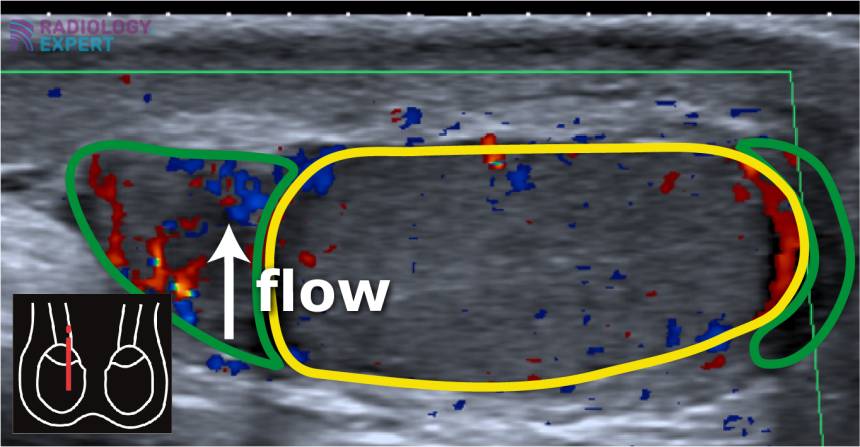 Scrotal ultrasound
