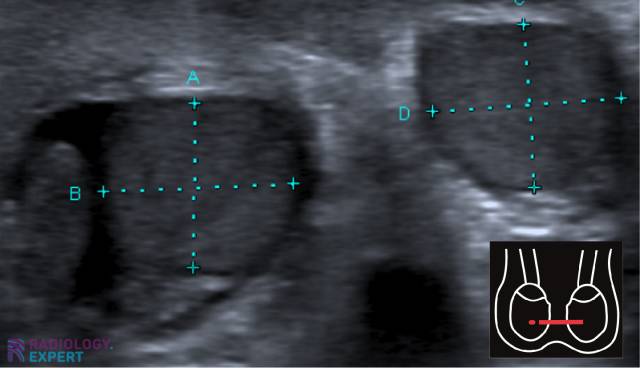 Scrotal Ultrasound