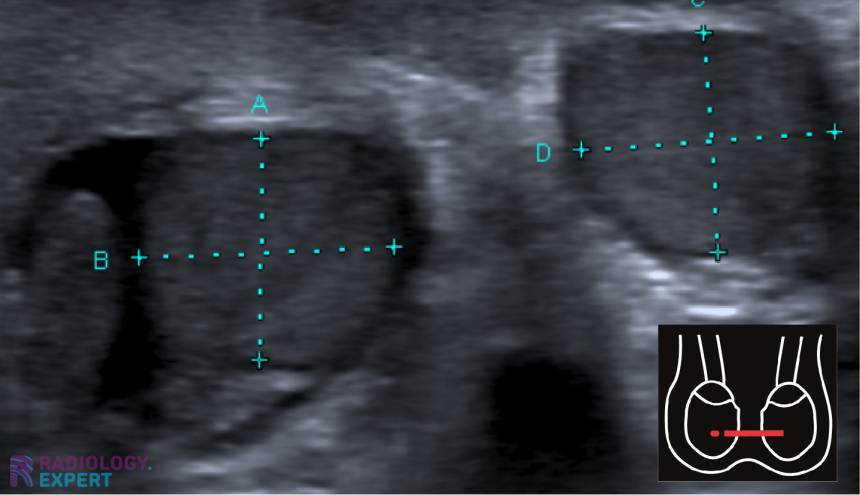 Scrotal ultrasound