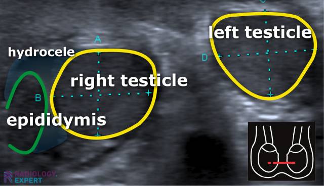 Scrotal ultrasound