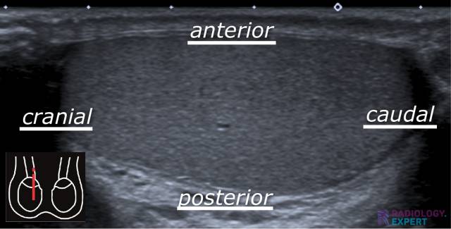 Scrotal Ultrasound
