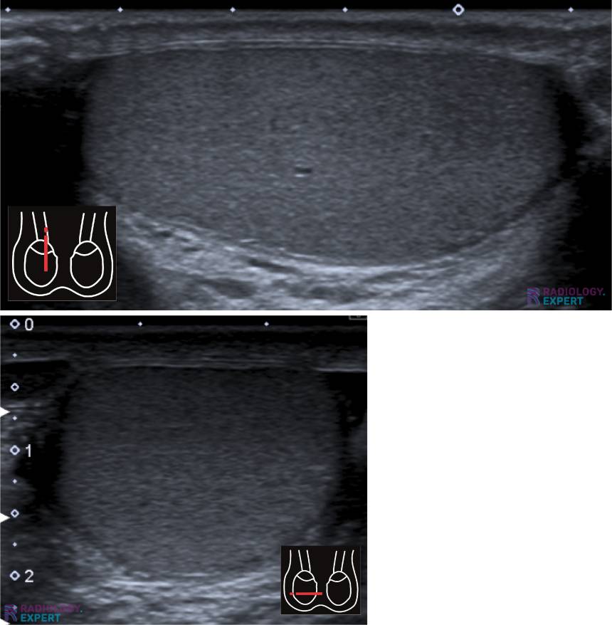 Scrotal ultrasound