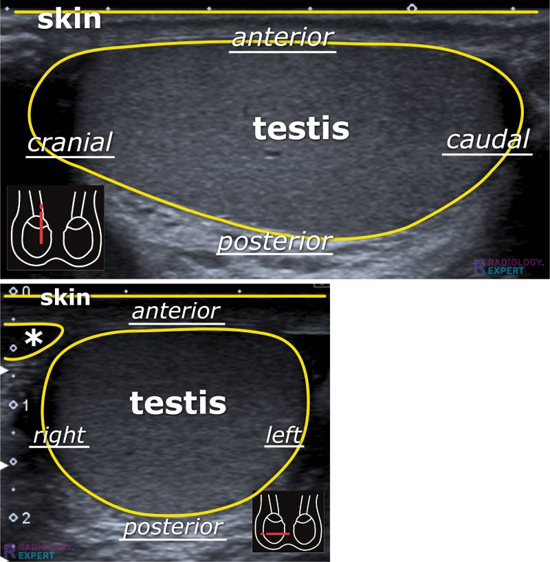 Scrotal Ultrasound