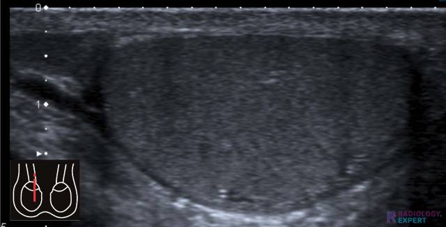 Scrotal ultrasound