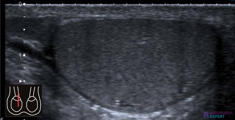 Scrotal ultrasound