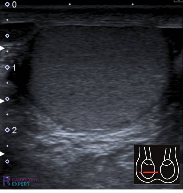 Echo scrotum
