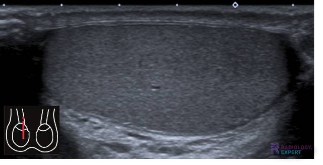 Echo scrotum