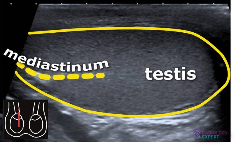 Echo scrotum
