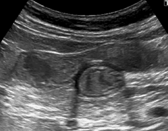Abdominal ultrasound