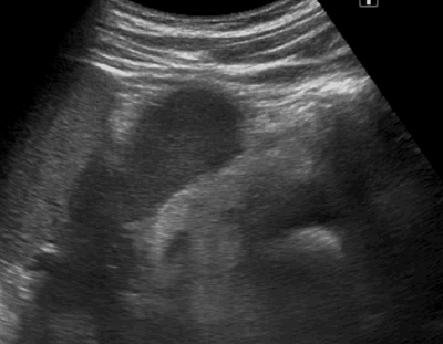 Abdominal ultrasound