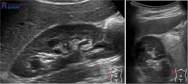 Kidney Ultrasound Images Normal 📃 Echogenic Kidneys, Bilateral