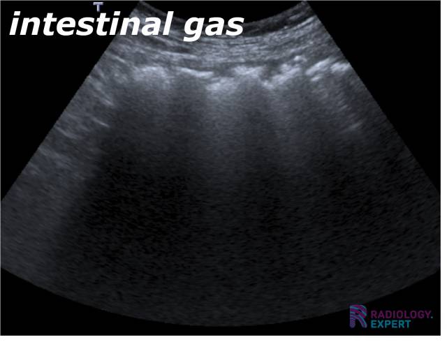 Abdominal ultrasound