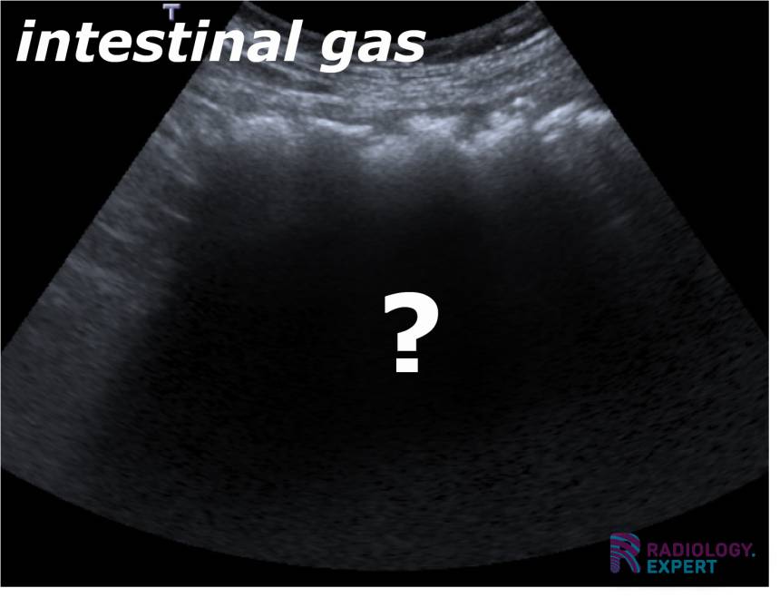 Abdominal ultrasound