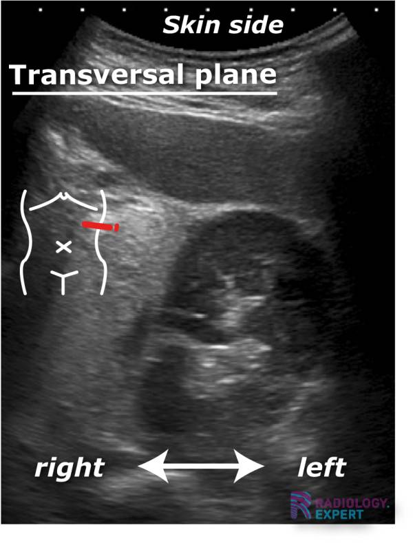Abdominal ultrasound