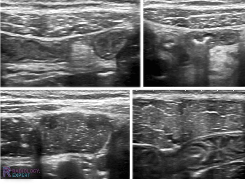 Abdominal ultrasound