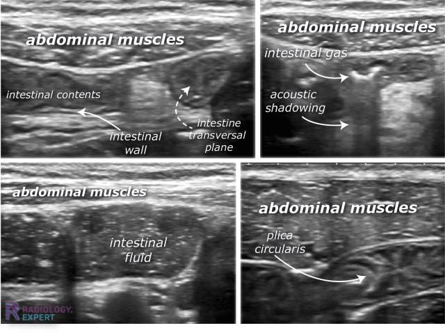 Abdominal ultrasound