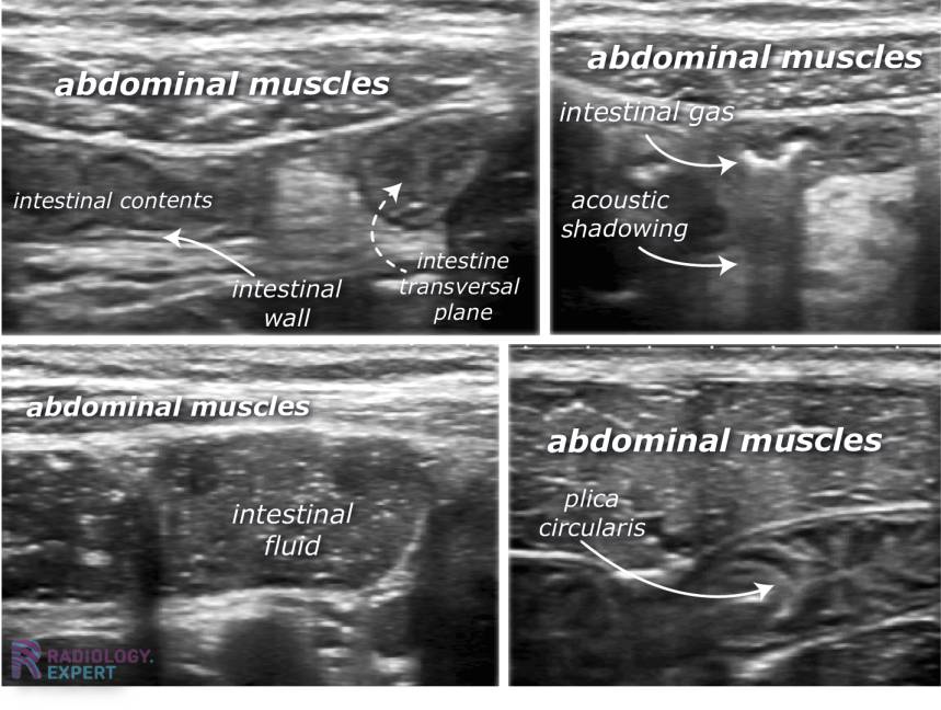 Abdominal ultrasound
