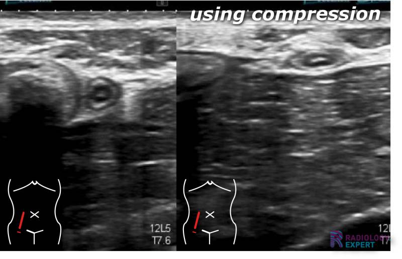 Abdominal ultrasound