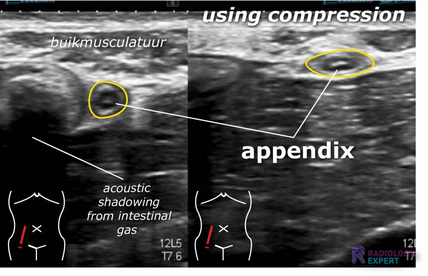 Abdominal ultrasound