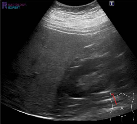 Abdominal ultrasound