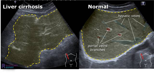 Abdominal ultrasound