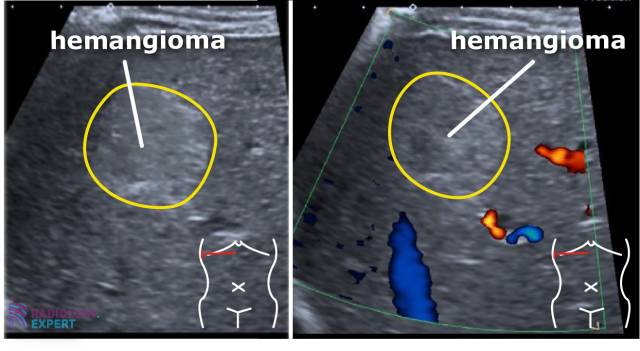 Abdominal ultrasound