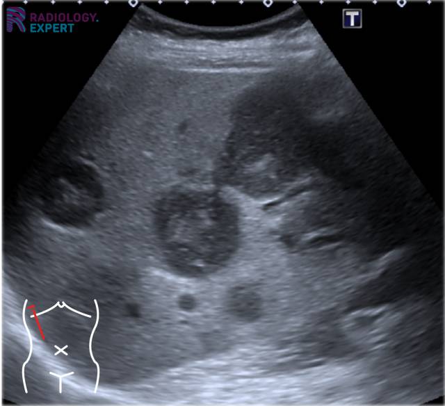 Abdominal ultrasound