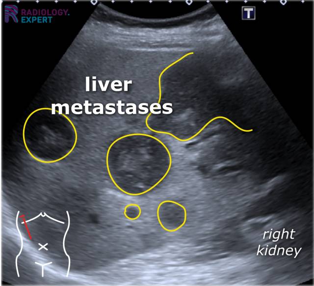 Abdominal ultrasound