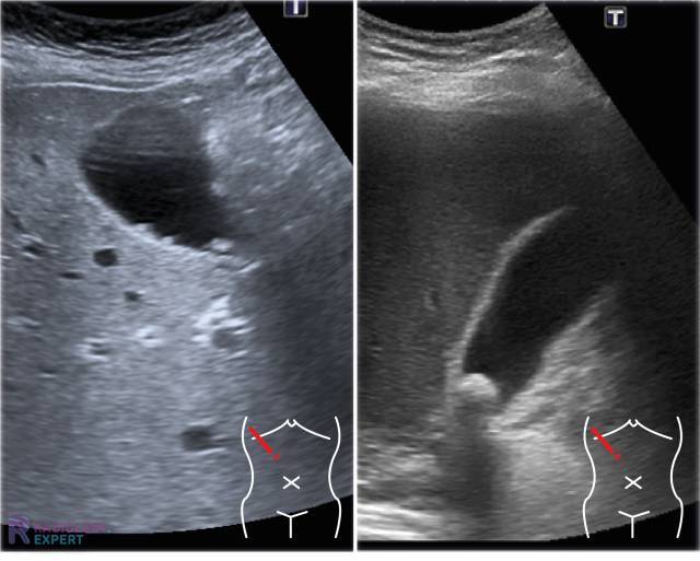 Abdominal ultrasound