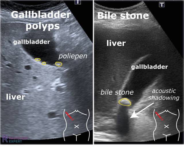 Abdominal ultrasound