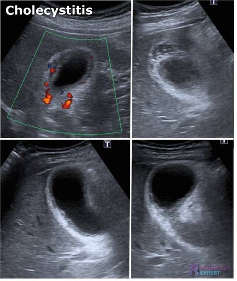 Abdominal ultrasound