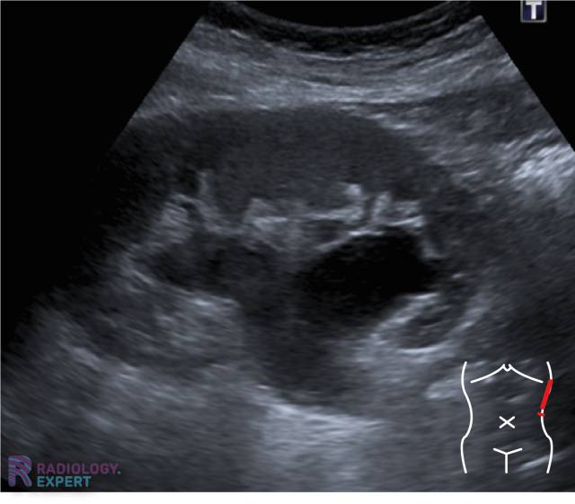 Abdominal ultrasound