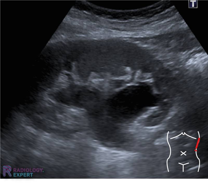 Abdominal ultrasound