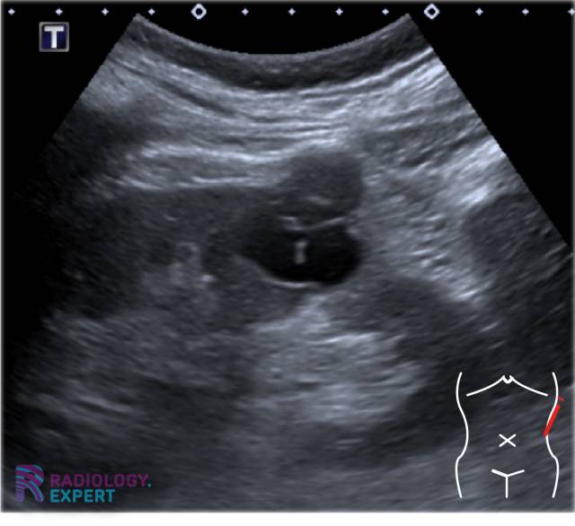 Abdominal ultrasound