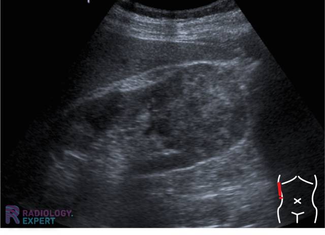 Abdominal ultrasound
