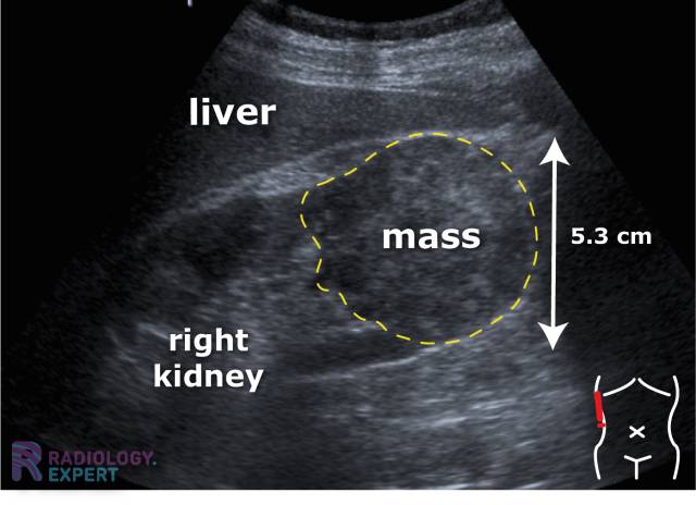 Abdominal ultrasound