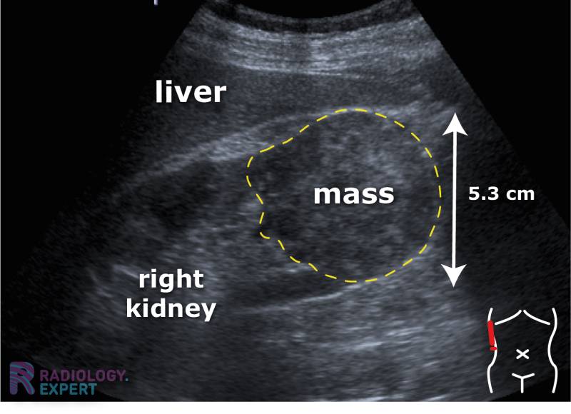 Abdominal ultrasound