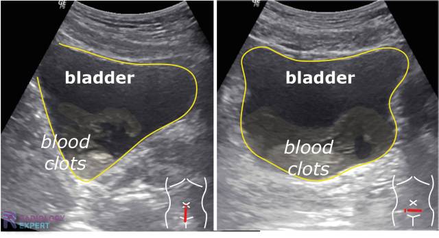 Abdominal ultrasound