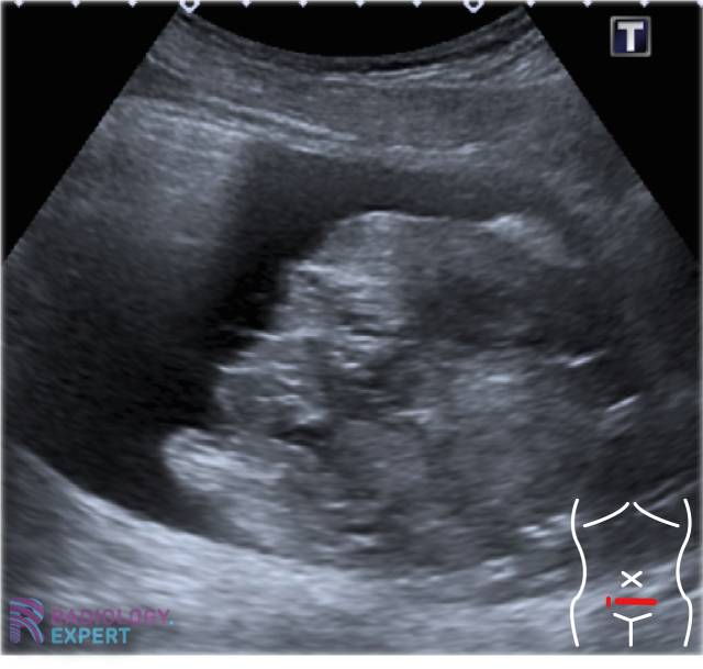 Abdominal ultrasound