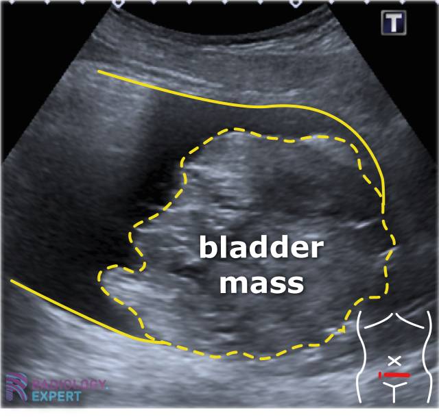 Abdominal ultrasound