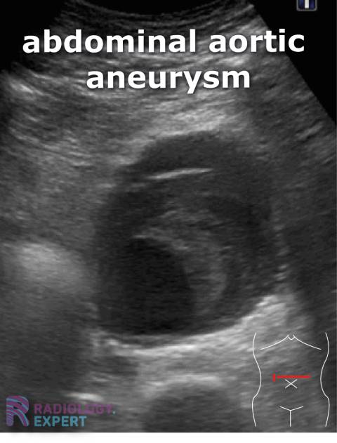 Abdominal ultrasound