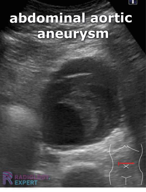 Abdominal ultrasound