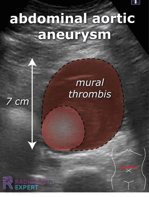 Abdominal ultrasound