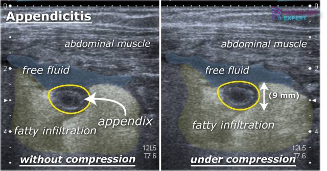 Abdominal ultrasound